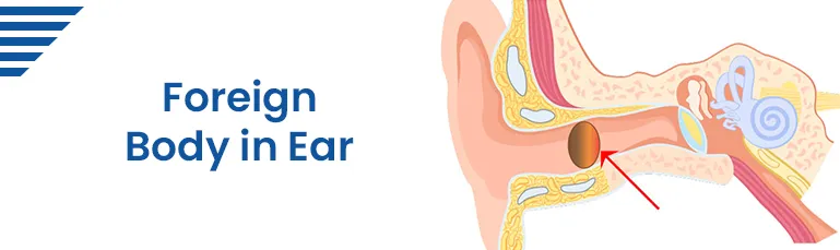 Foreign Body in Ear : Symptoms, Causes, Remedies & Treatments